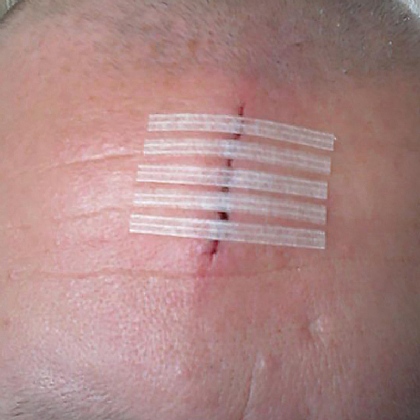 HypaCover Skin Closure Strips, 6.4 x 76mm, Pouch of 6 | Skin Closures ...